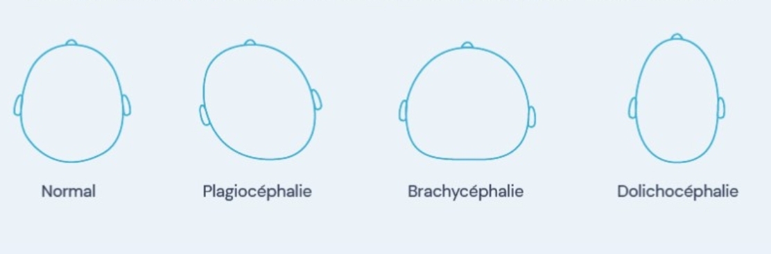 La plagiocéphalie : comment l'éviter ? - Parlonsbambins